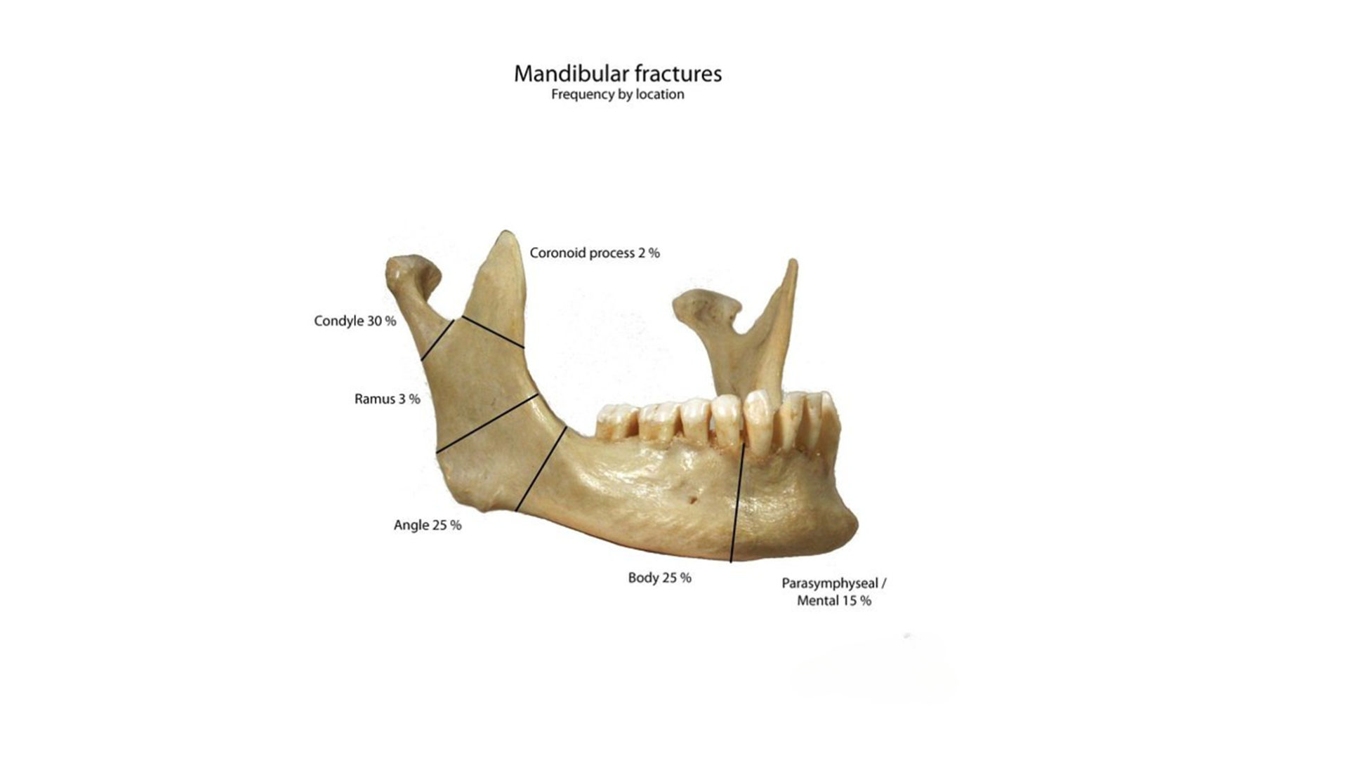Jaw Fracture - niravpateldentalclinic.com