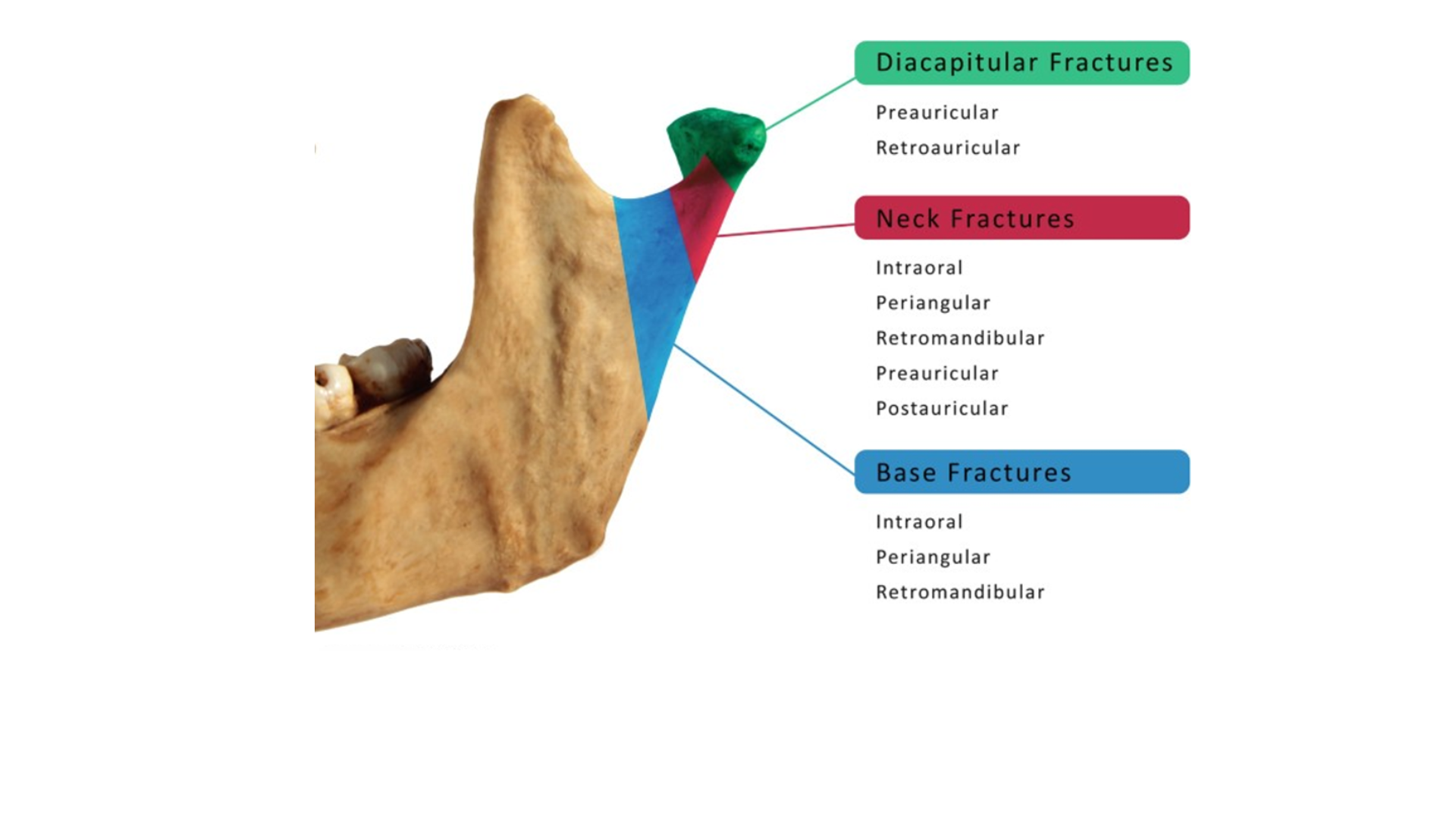 Symptoms of a Jaw Fracture