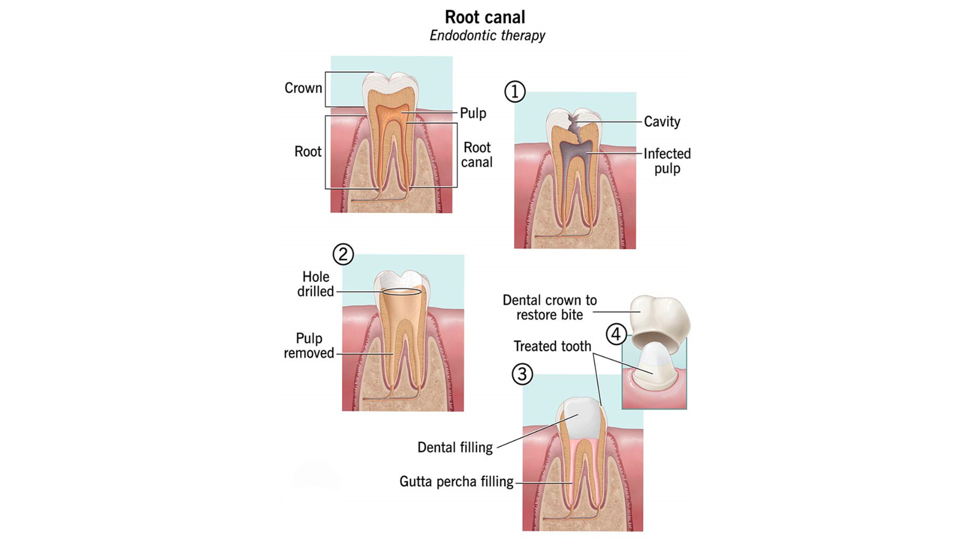 Root Canal Theraphy - niravpateldentalclinic.com