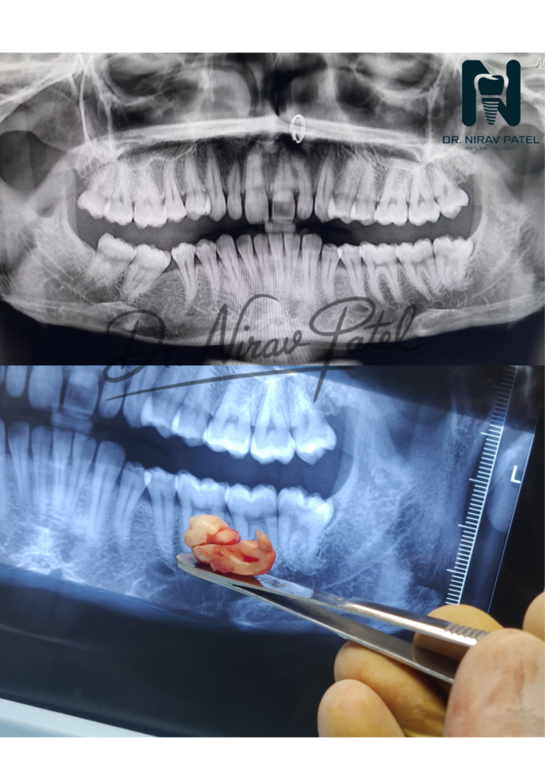Wisdom Tooth Removal - niravpateldentalclinic.com